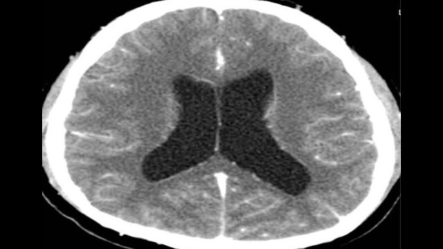 Brain-damaging tapeworm infections surge in Mumbai: Know key symptoms ...