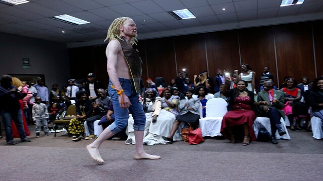 Albinism pageant in Zimbabwe joyfully breaks down prejudice - CNBC TV18