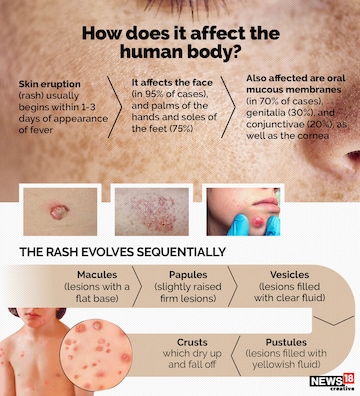 Monkeypox outbreak still a global health emergency — WHO lists reasons ...