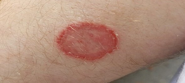 First instances of highly contagious ringworm strain found in US, check ...