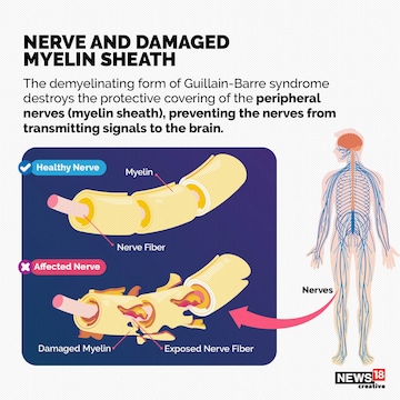 Peru declares health emergency after surge in Guillain-Barré Syndrome cases — more on this rare ...